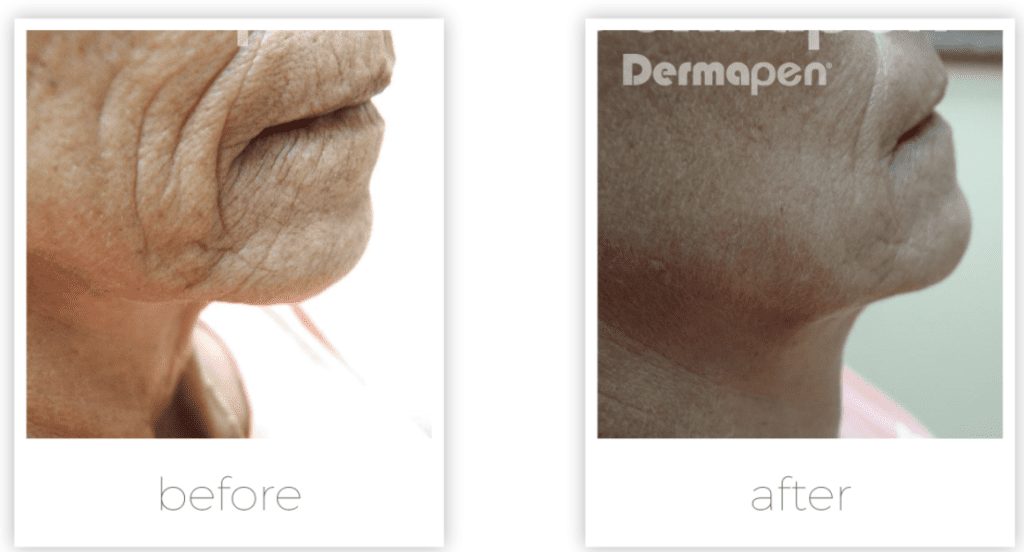 Medical Micro Needling - Reading, PA | The Spa At Spring Ridge