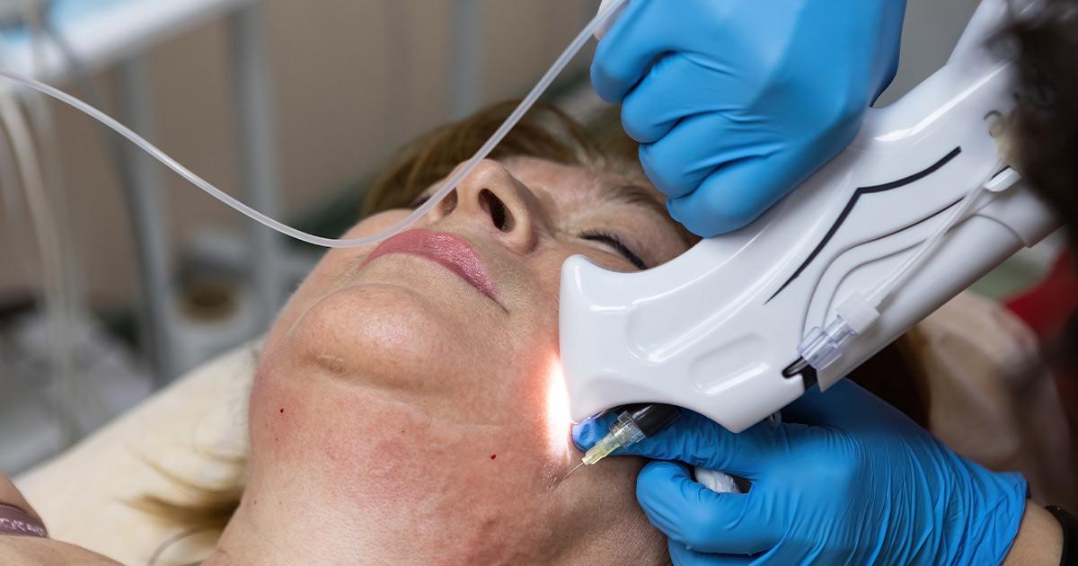 Laser Treatments For Acne Scars: What You Need To Know